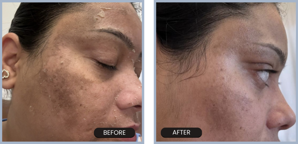 Algae Peel Is The Best Treatments For A Glowing Skin