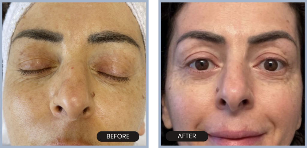 Algae Peel Is The Best Treatments For A Glowing Skin